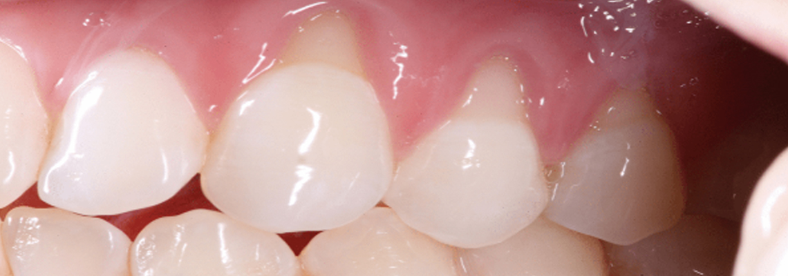 Find What Causes Gum Recession?, and Treatment for Receding Gums