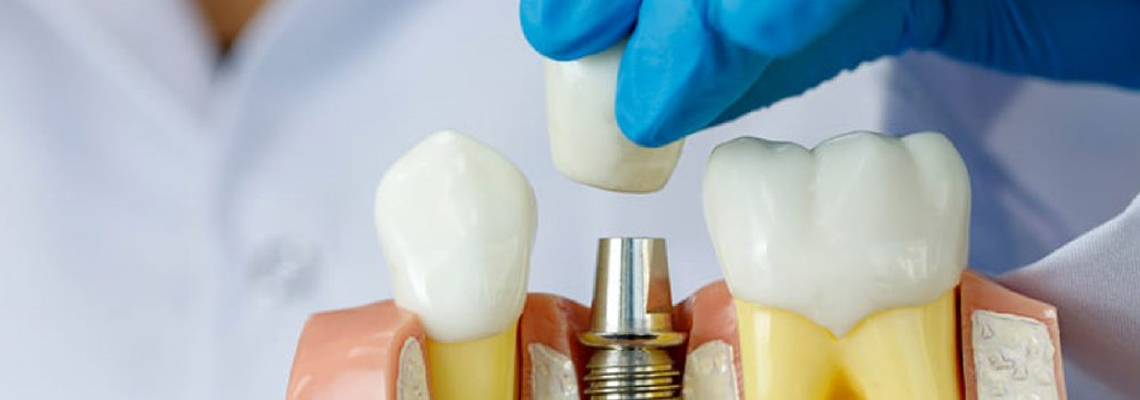 Future Trends: Implants Without Bone Grafts - Dr.Motiwala Dental Clinic